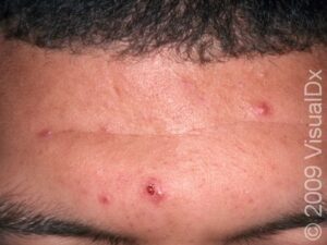 Acne Excoriée: Causes, Symptoms, and Treatment - Skinsight