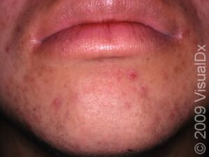 Acne Excoriée: Causes, Symptoms, and Treatment - Skinsight