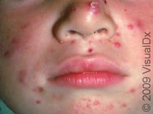 Acne (Acne Vulgaris) Condition, Treatments and Pictures for Children ...