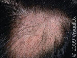 Alopecia Areata: Causes, Symptoms, and Treatment