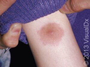 Bug Bite or Sting Condition, Treatments and Pictures for Adults - Skinsight