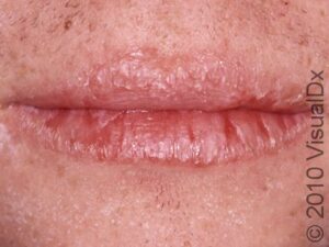 Cheilitis: Causes, Treatment, and Prevention - Skinsight
