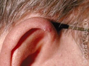 Chondrodermatitis Nodularis Helicis Condition, Treatments and Pictures ...