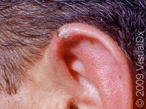 Chondrodermatitis Nodularis Helicis Condition, Treatments and Pictures ...