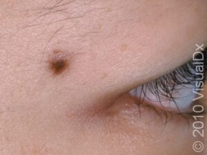 Mole (Nevus) Condition, Treatments and Pictures for Children - Skinsight