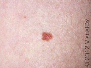 Mole (Nevus) Condition, Treatments and Pictures for Adults - Skinsight