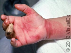 Allergic Contact Dermatitis (Pediatric) Condition, Treatments and ...
