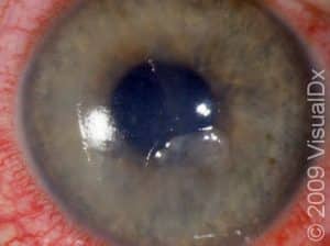 Corneal Abrasion Condition, Treatments and Pictures for Adults - Skinsight