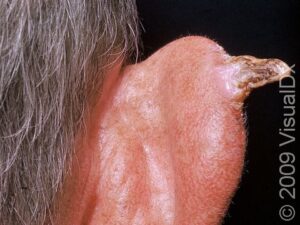 Cutaneous Horn: Causes, Diagnosis, and Treatment - Skinsight