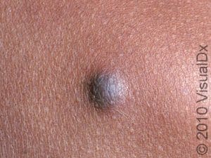 Dermatofibroma: Symptoms, Treatment, and Removal - Skinsight