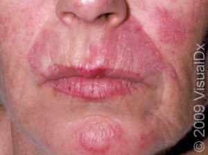 Discoid Lupus Erythematosus Condition, Treatments and Pictures for ...