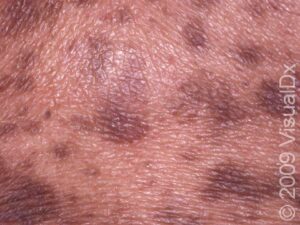 Drug Eruption | Symptoms & Treatment - Skinsight