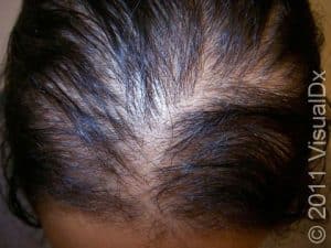 Hair Loss, Female Pattern Baldness (Female Pattern Alopecia) Condition ...
