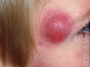 Boils (Furunculosis) Condition, Treatments and Pictures for Children ...