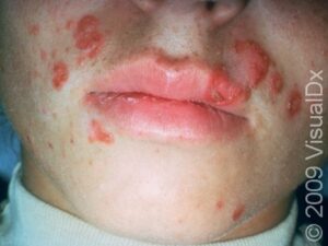 Impetigo Condition, Treatments and Pictures for Children - Skinsight