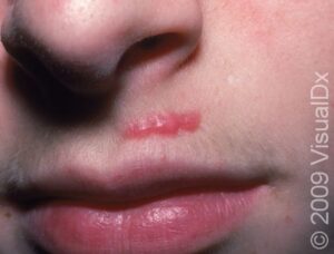 Keloid Condition, Treatments and Pictures for Children - Skinsight