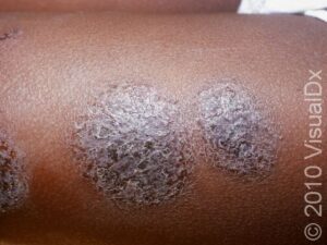 Nummular Dermatitis: Causes, Symptoms, and Treatment
