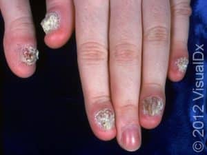 Nail Infection, Fungal (Onychomycosis) Condition, Treatments and ...