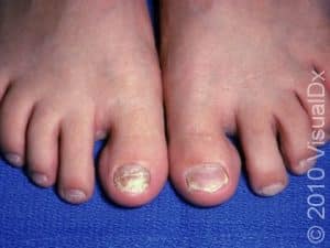 Nail Infection, Fungal (Onychomycosis) Condition, Treatments and ...