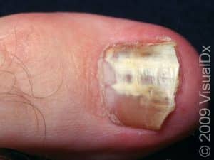 Nail Infection, Fungal (Onychomycosis) Condition, Treatments and ...