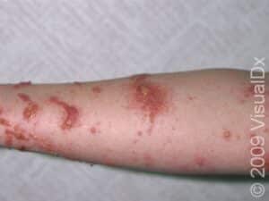 Poison Ivy, Oak, and Sumac Condition, Treatments and Pictures for ...