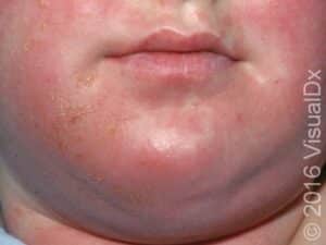 Poison Ivy, Oak, and Sumac Condition, Treatments and Pictures for ...