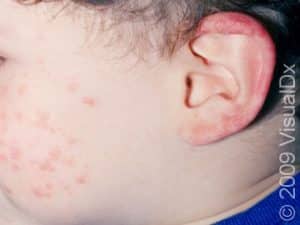 Roseola (Sixth Disease) Condition, Treatments and Pictures for Infants ...