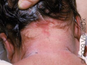 Salmon Patch Condition, Treatments and Pictures for Infants - Skinsight