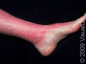 Sunburn Condition, Treatments and Pictures for Adults - Skinsight