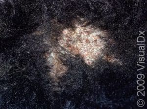 Scalp Ringworm (Tinea Capitis) Condition, Treatments and Pictures for ...