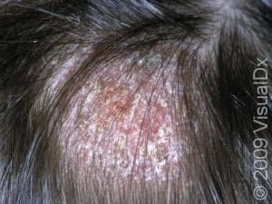 Scalp Ringworm (Tinea Capitis) Condition, Treatments and Pictures for ...