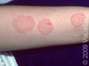 Ringworm (Tinea Corporis) Condition, Treatments and Pictures for ...