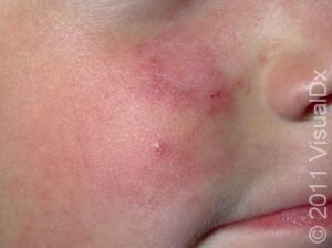 Facial Ringworm (Tinea Faciei) Condition, Treatments and Pictures for ...
