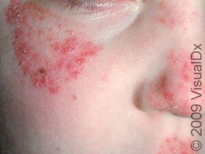 Facial Ringworm (Tinea Faciei) Condition, Treatments and Pictures for ...