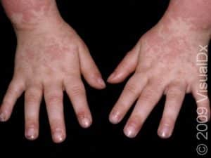 Viral Exanthem Condition, Treatments and Pictures for Children - Skinsight