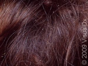 Head Lice (Pediculosis Capitis) Condition, Treatments and Pictures for ...