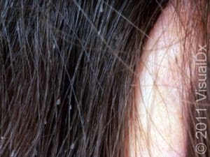 Head Lice (Pediculosis Capitis) Condition, Treatments and Pictures for ...