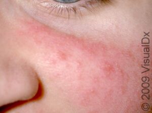 Rosacea Condition, Treatments and Pictures for Adults - Skinsight