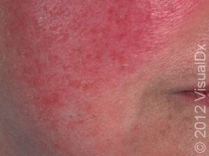 Rosacea Condition, Treatments and Pictures for Adults - Skinsight