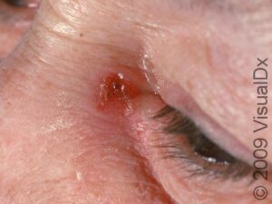 Squamous Cell Carcinoma Condition, Treatments and Pictures for Adults ...