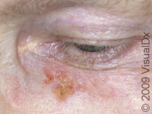 Squamous Cell Carcinoma Condition, Treatments and Pictures for Adults ...