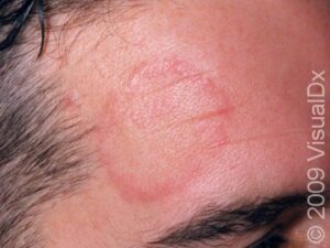 Tinea Faciei (Ringworm on Face): Causes, Symptoms, & Treatment