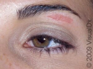 Burns, First Aid Condition, Treatments and Pictures for - Skinsight