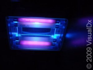 Wood’s Lamp Examination Condition, Treatments and Pictures for - Skinsight