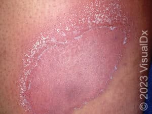 Generalized Pustular Psoriasis Condition, Treatments and Pictures for ...