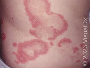 Generalized Pustular Psoriasis Condition, Treatments and Pictures for ...