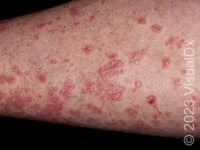 Guttate Psoriasis in Adults: Causes, Symptoms, and Treatment
