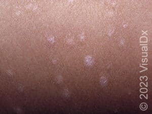 Guttate Psoriasis Condition, Treatments and Pictures for Children ...